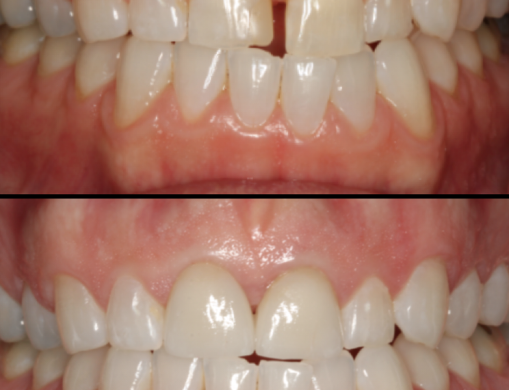 Treatment for recession - Burlington Smiles Dental